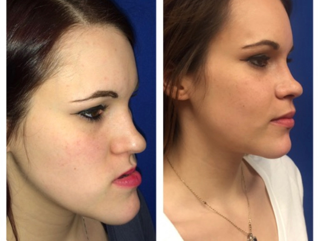 Orthognathic Jaw Surgery | Oral Surgeon in Philadelphia