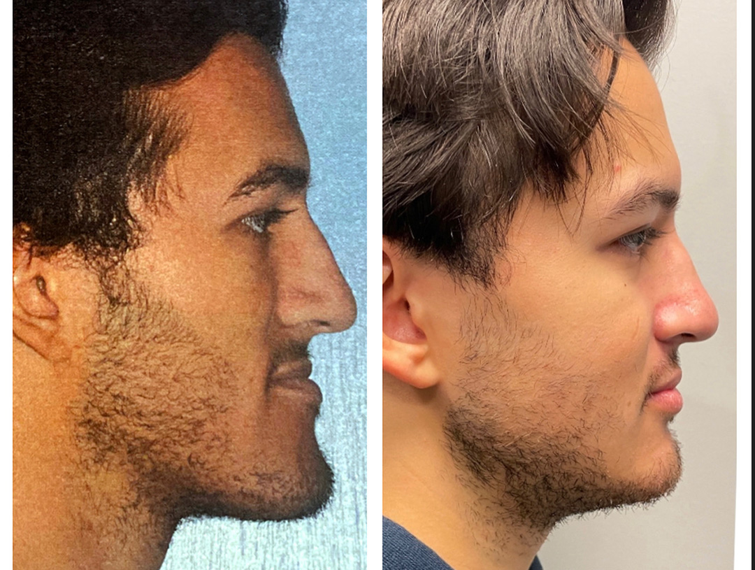 Orthognathic (Jaw) Surgery - Philadelphia Oral & Maxillofacial Surgery ...